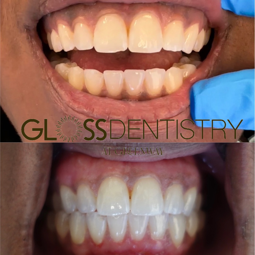 Laser Gum Bleaching in 77098 | Gum Hyperpigmentation in Houston, TX